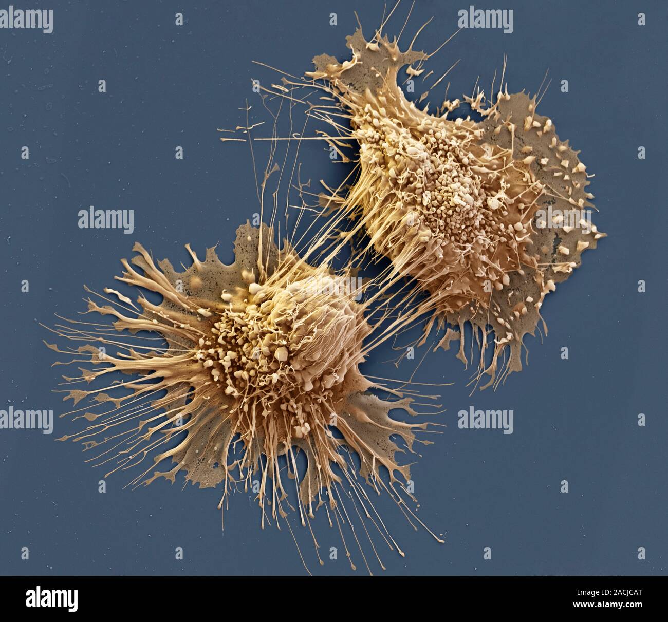 Dividing cancer cells. Coloured scanning electron micrograph (SEM) of ...