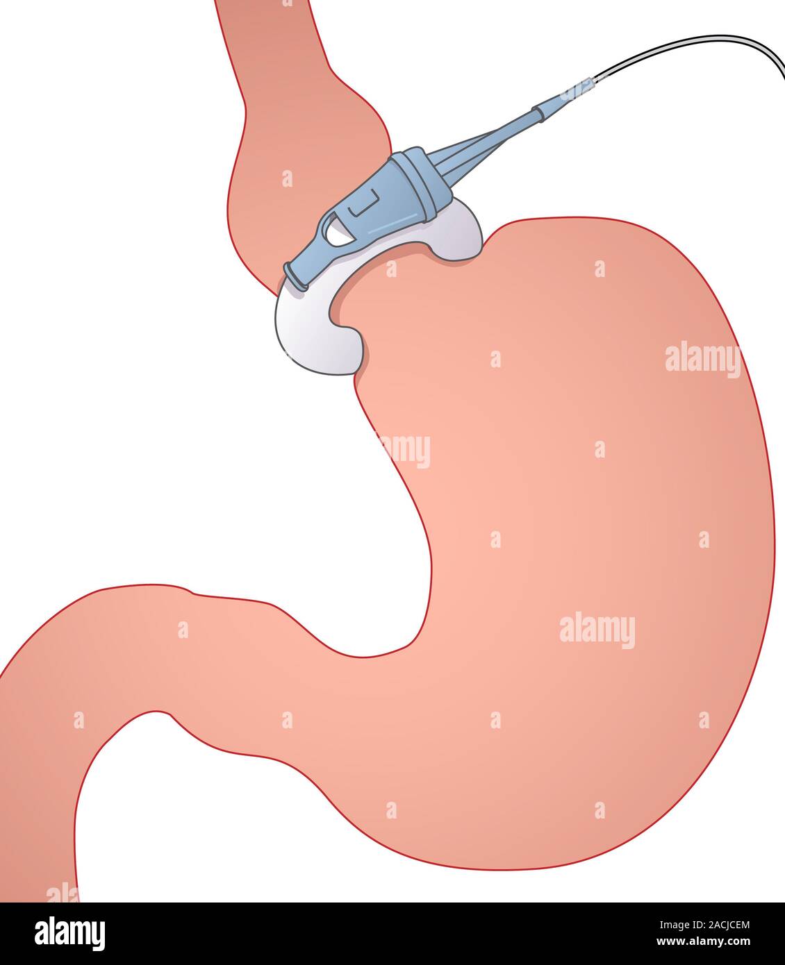 Artwork of an adjustable gastric band fitted around the stomach to ...