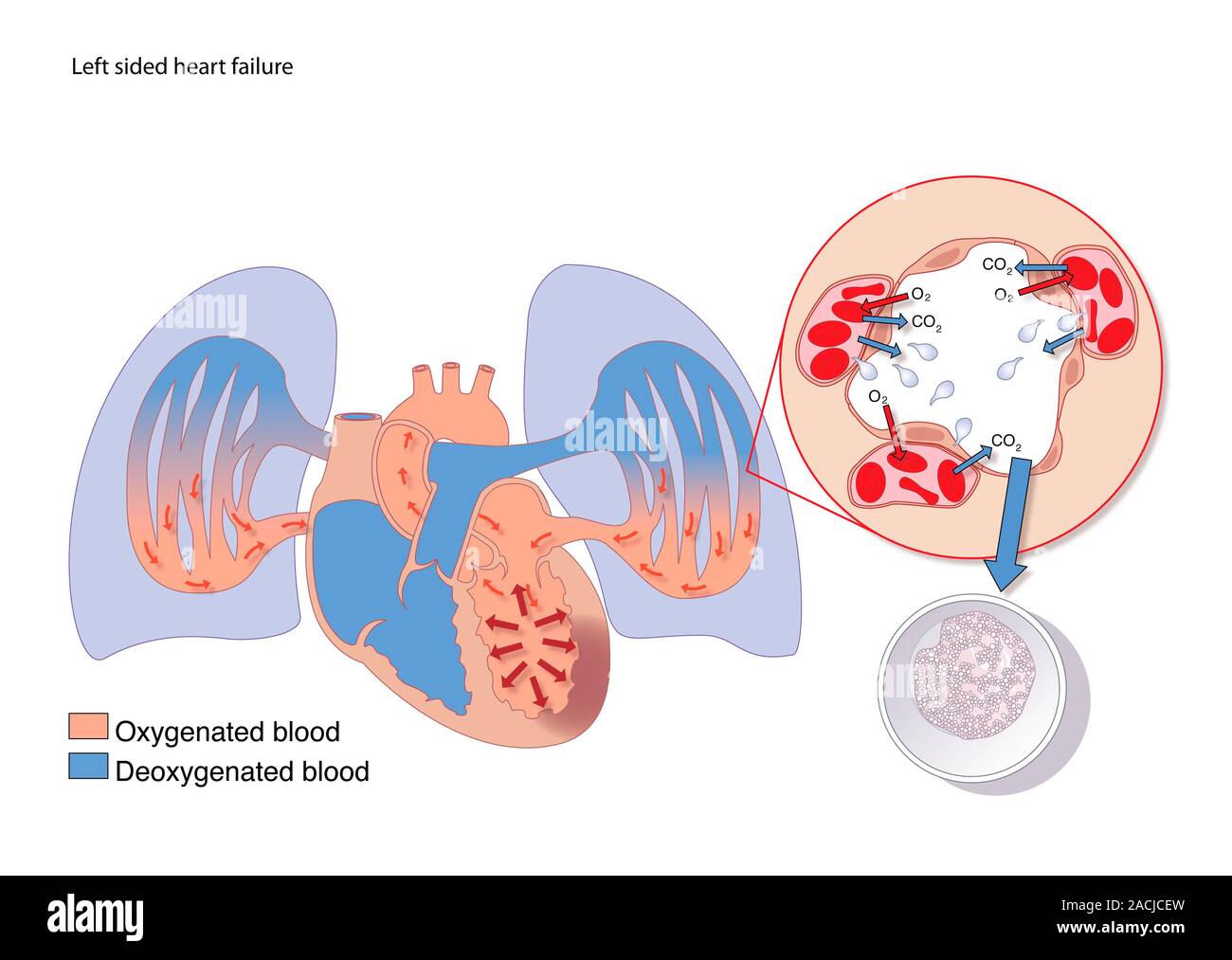 Artwork of left-sided heart failure showing damaged heart muscle (brown ...