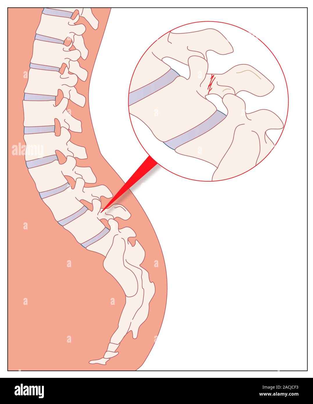 Artwork Side View Of The Vertebrae Of The Spine Showing A Stress Fracture Inset Of The Pars