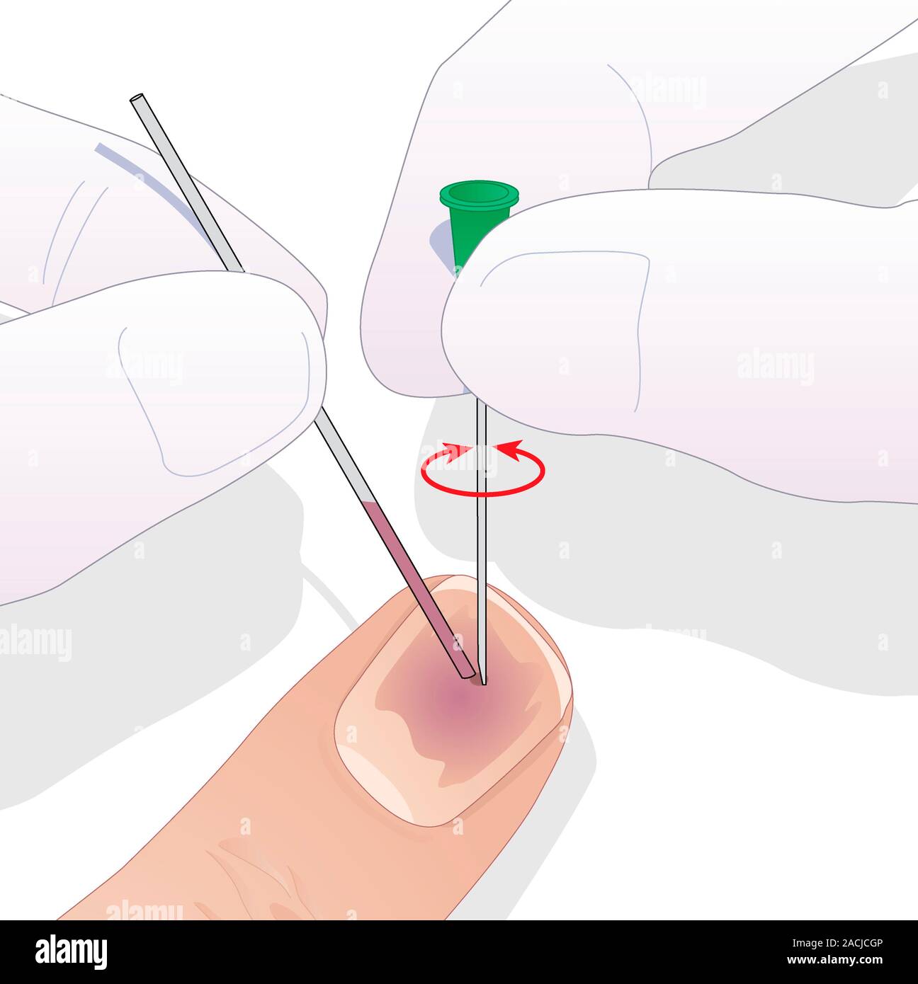 Artwork of bleeding (bruising) beneath the fingernail (subungual ...