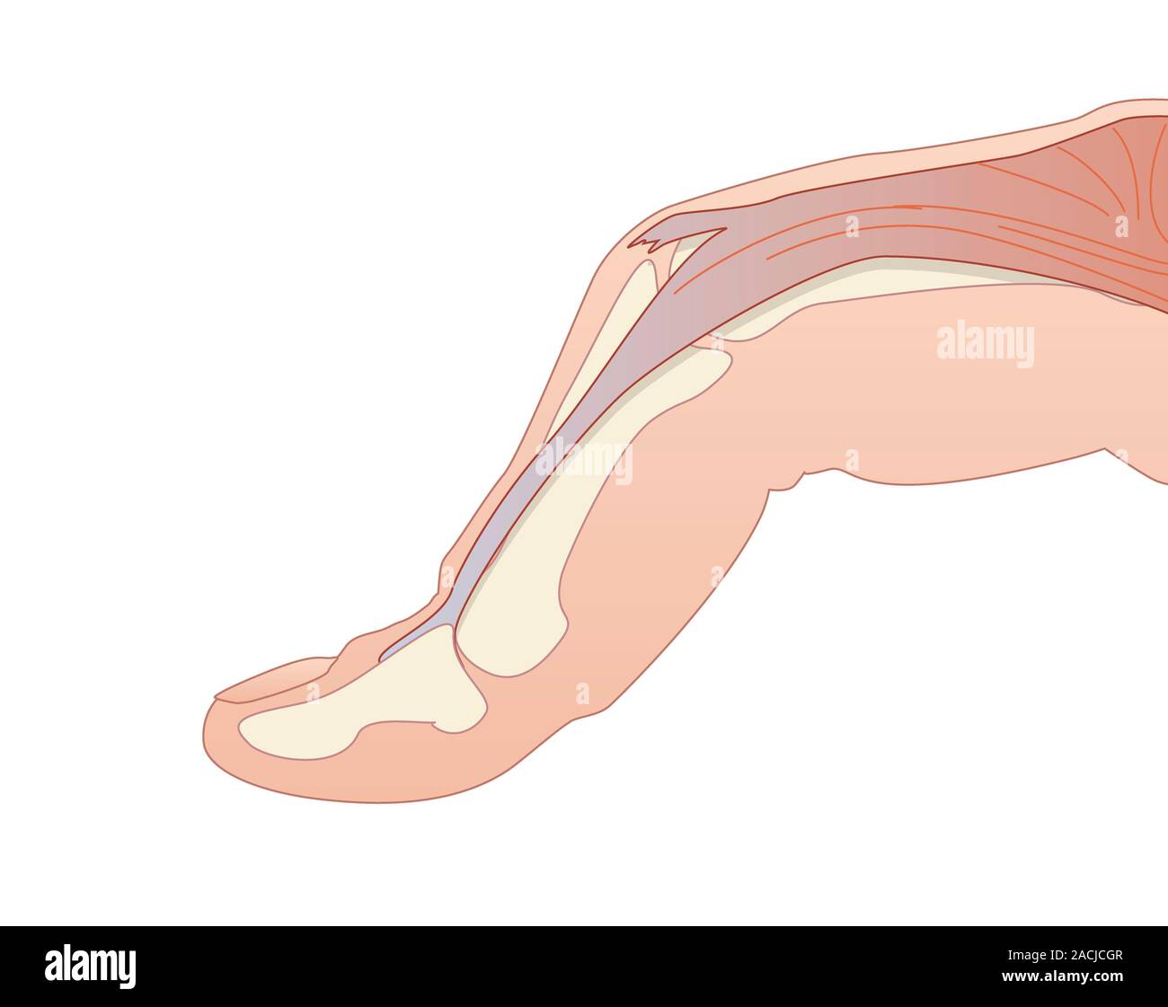Artwork of the anatomy of trigger finger, a condition arising when the ...