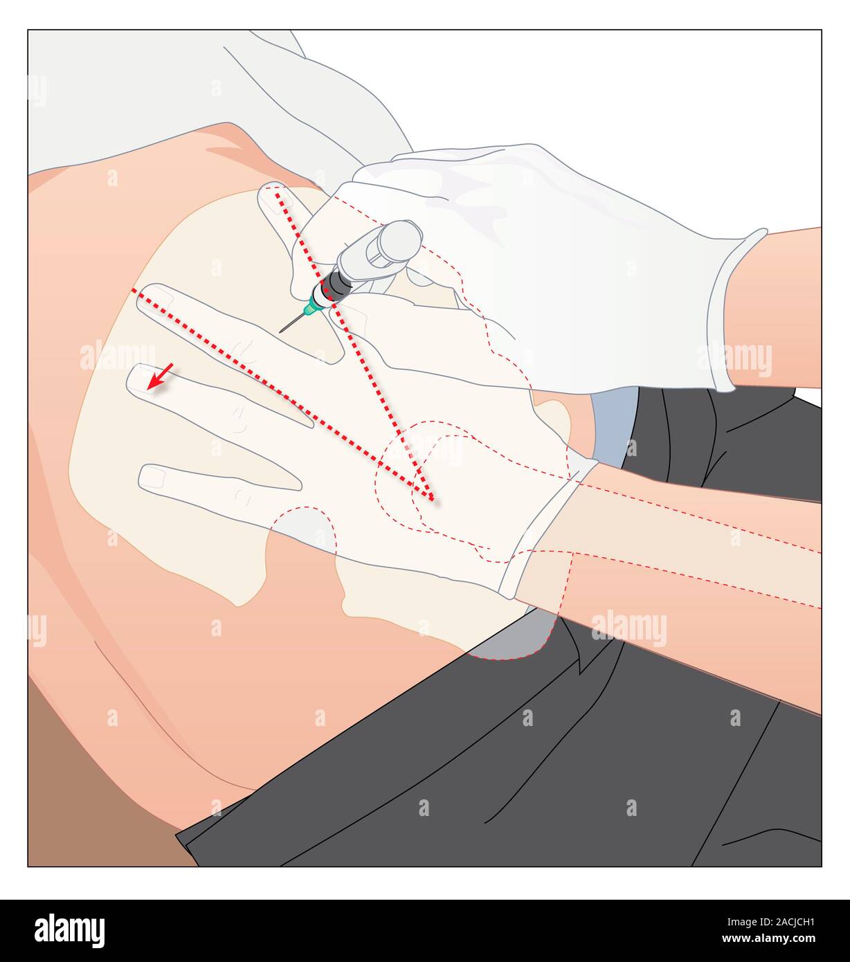 Artwork showing gloved hands on the side of a patient's buttock while ...