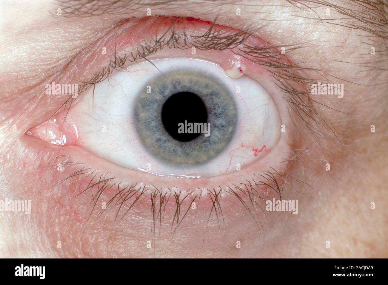 Stye bacterial eye infection. The style is the white rounded area at ...