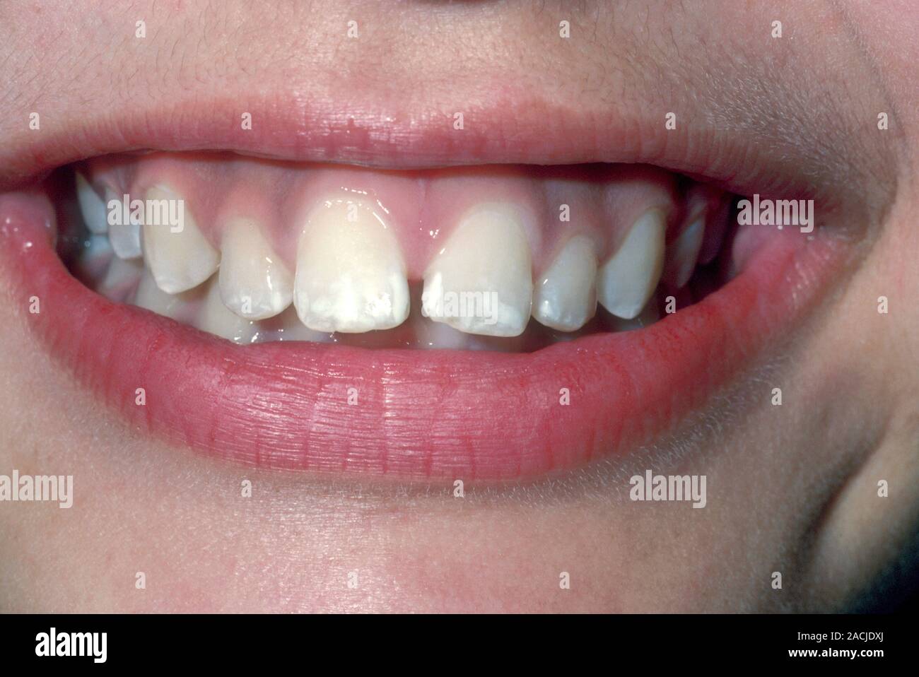 Overbite. 10 year old female with a 100 per cent overbite. Her upper ...