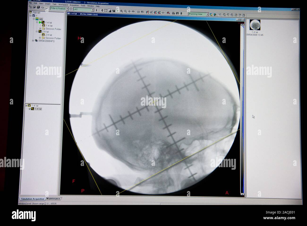 Radiotherapy simulator. Image of a patient's head acquired by an X-ray ...