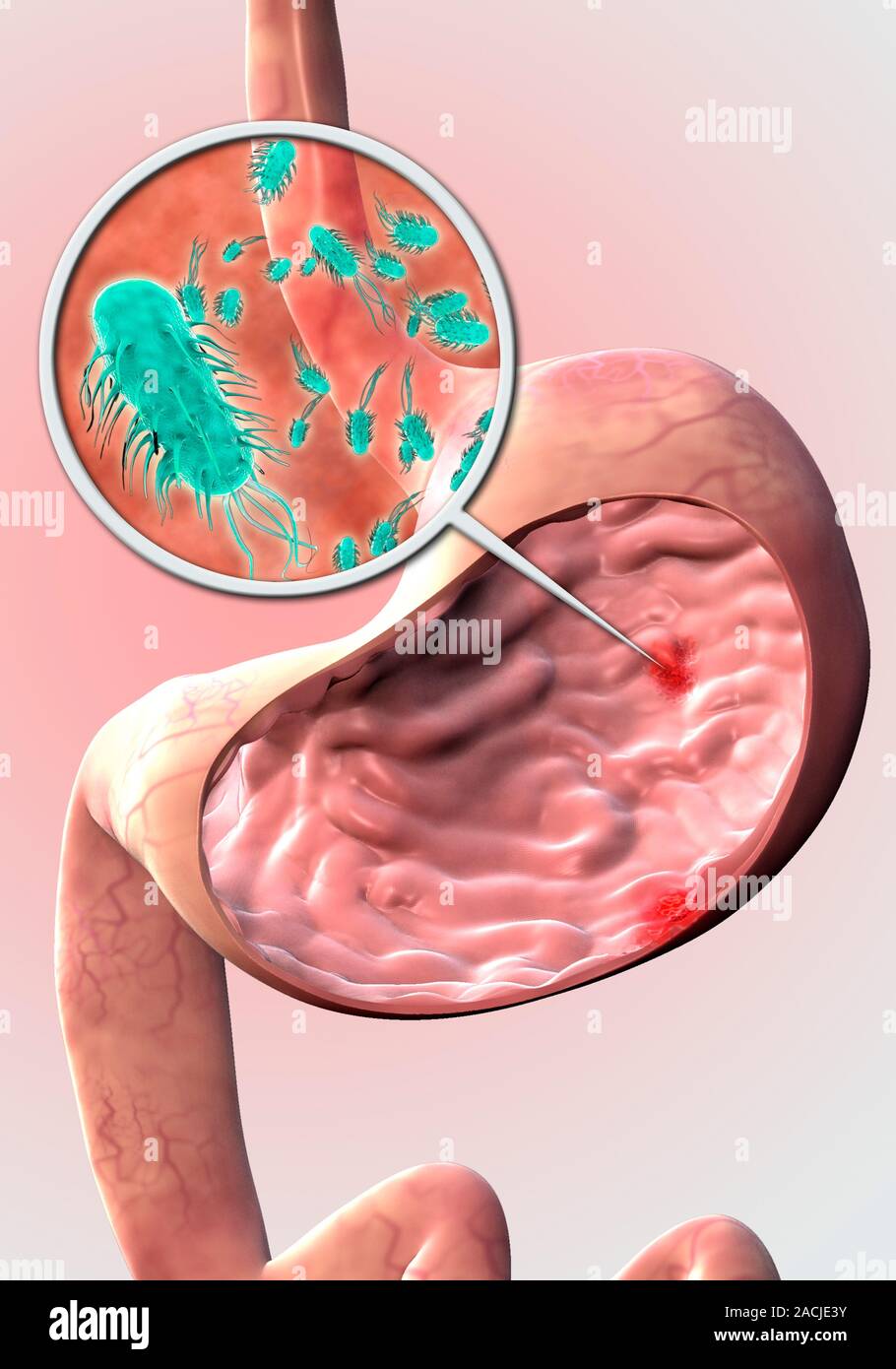 Gastric ulcers. Computer artwork of ulcers (red) caused by Helicobacter ...