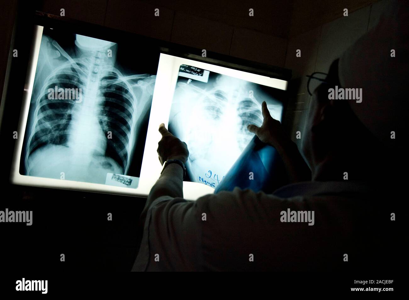 Bird flu infection. Doctor examining chest X-rays of a person who has ...