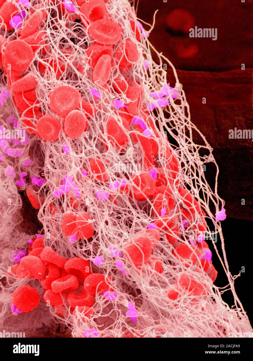 Blood clot, coloured scanning electron micrograph (SEM). Red blood ...