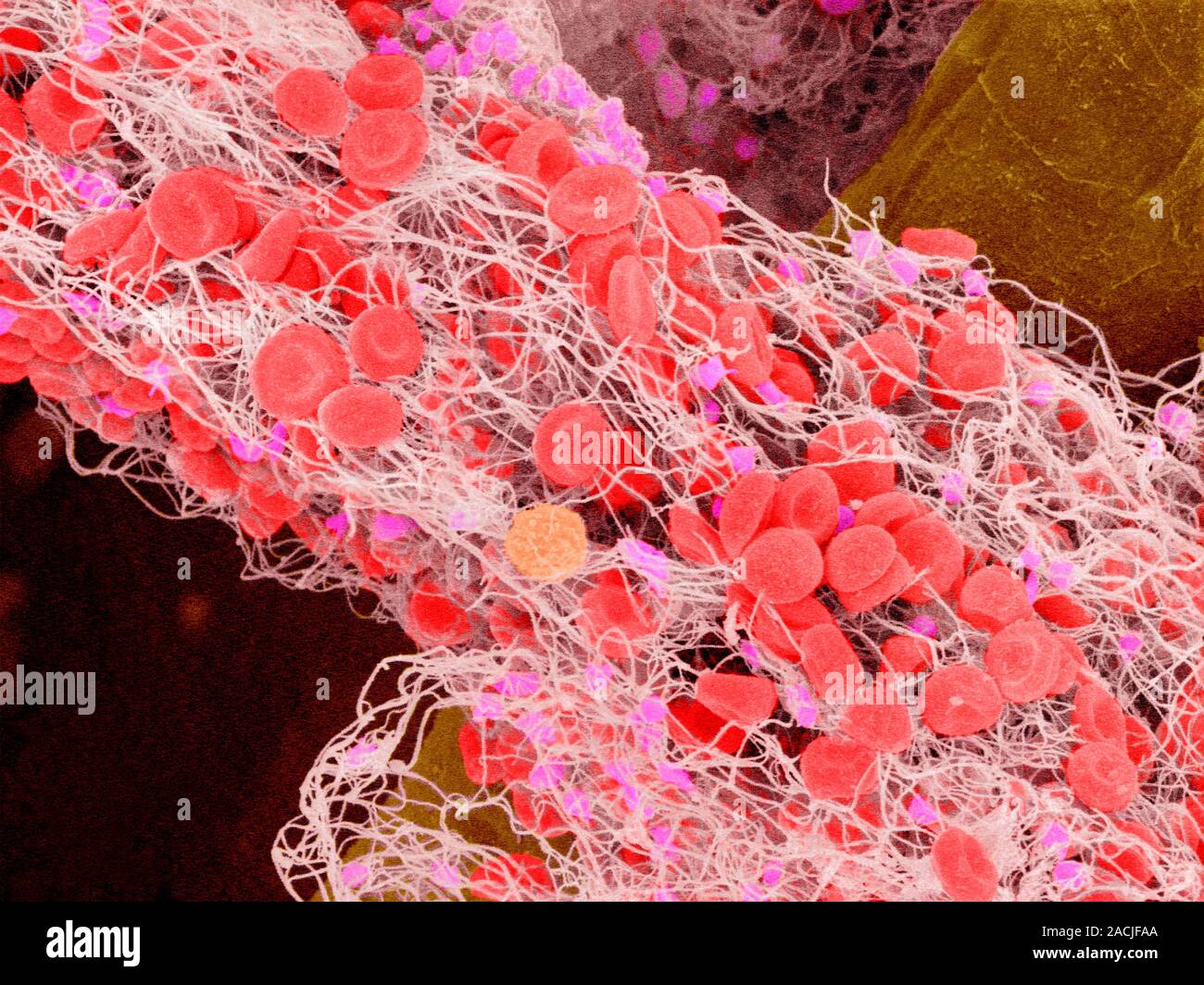Blood clot, coloured scanning electron micrograph (SEM). Red blood ...