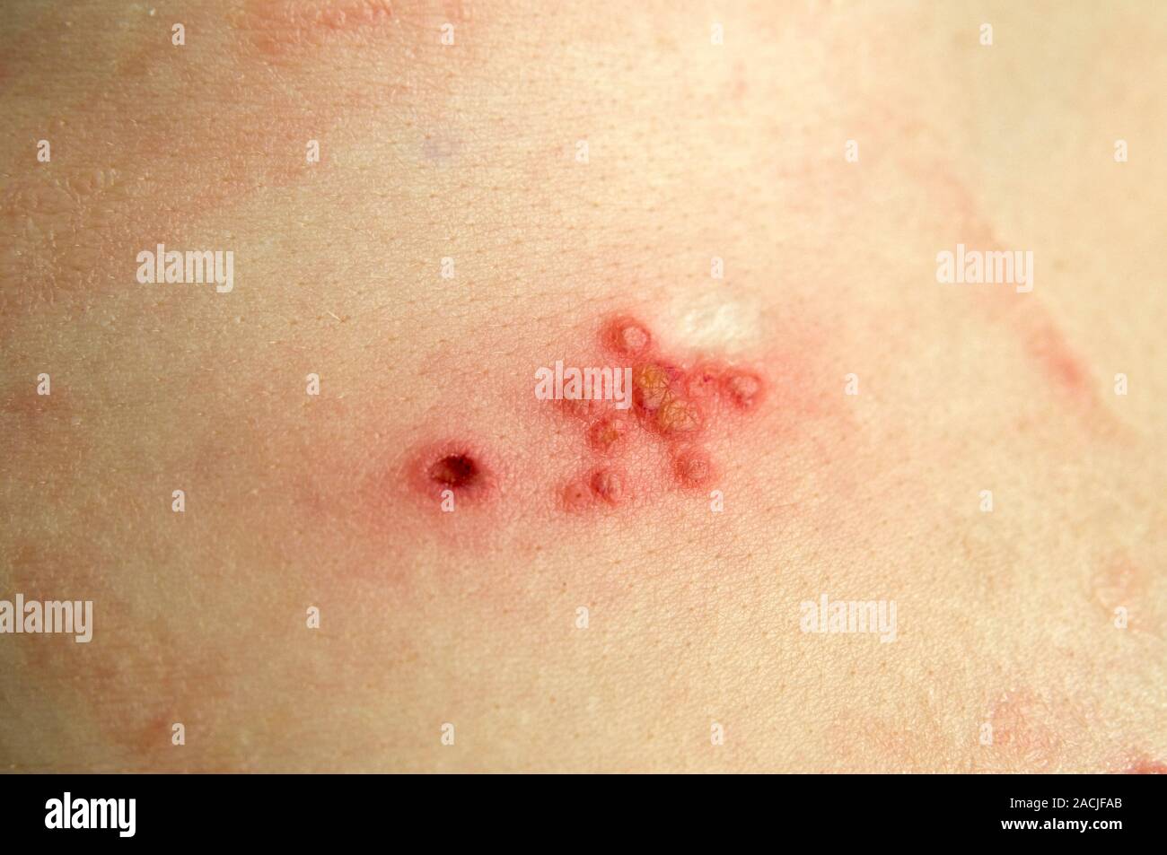 Shingles, or herpes zoster, rash on the skin of a 31 year old woman ...