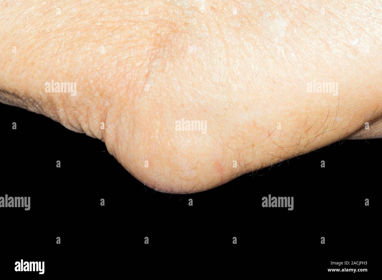 Close-up of the swollen elbow joint (olecranon) in an 84 year old male ...