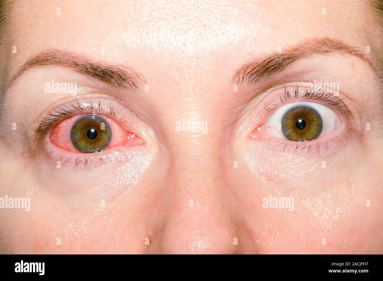 Episcleritis of the eye (at left) in a 47 year old female patient ...