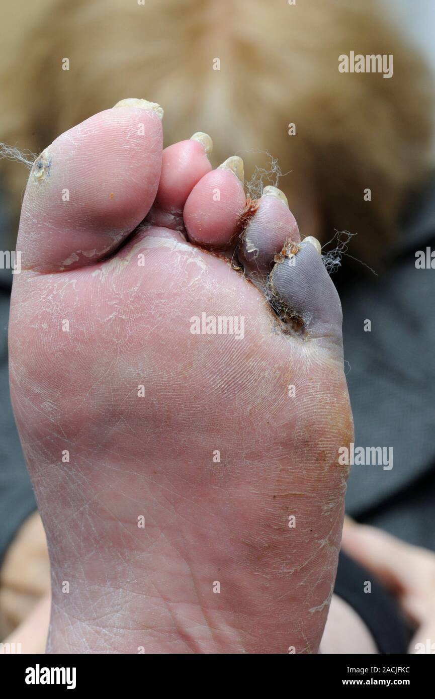 Not for use in Television Not for use in Television Swollen and cracked ...