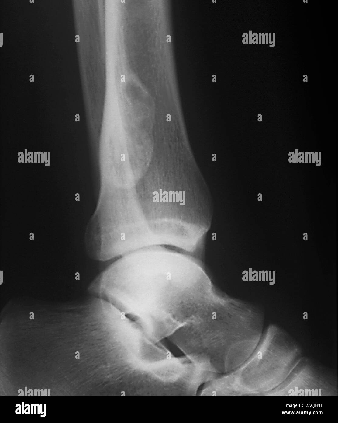 Fibrosis on lower leg. X-ray (side view) of the right ankle of a ...