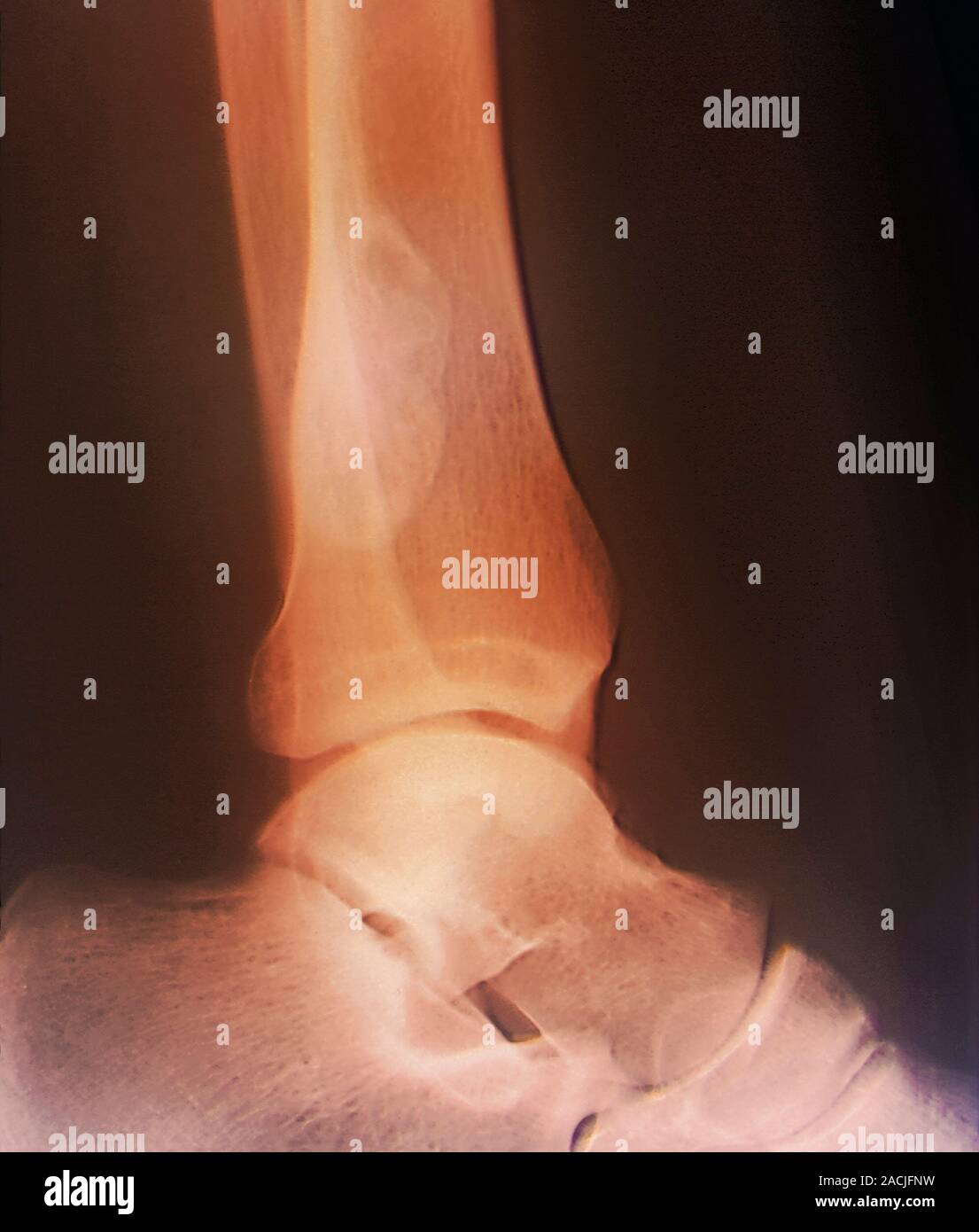 Fibrosis on lower leg. Coloured X-ray (side view) of the right ankle of ...