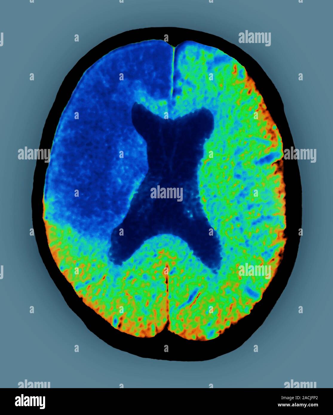 Coloured computed tomography (CT) scan in axial section of the brain of a 65 year old patient ...