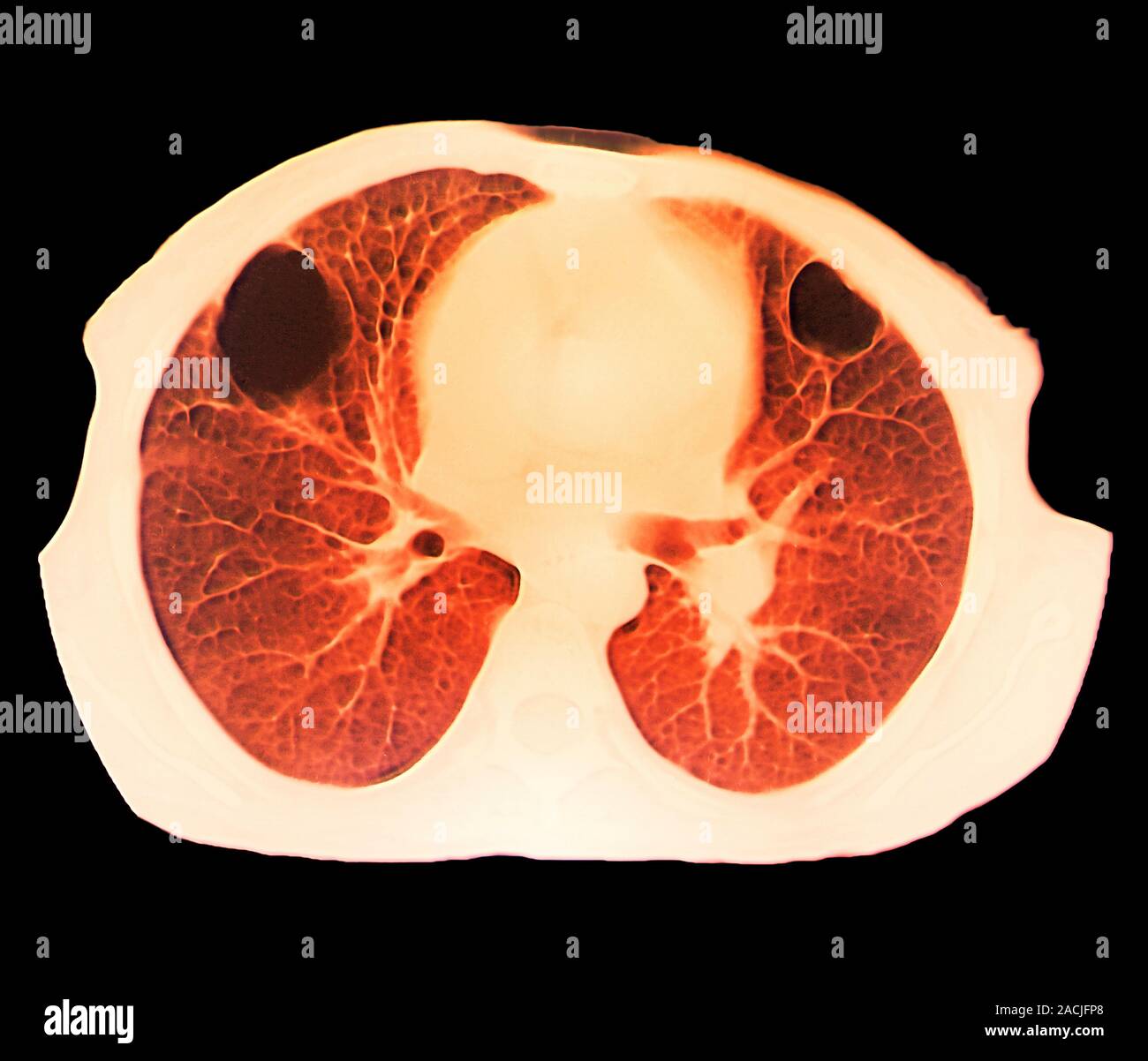 Coloured computed tomography (CT) scan in axial view of the lung fields ... Coloured computed tomography (CT) scan in axial view of the lung fields ...