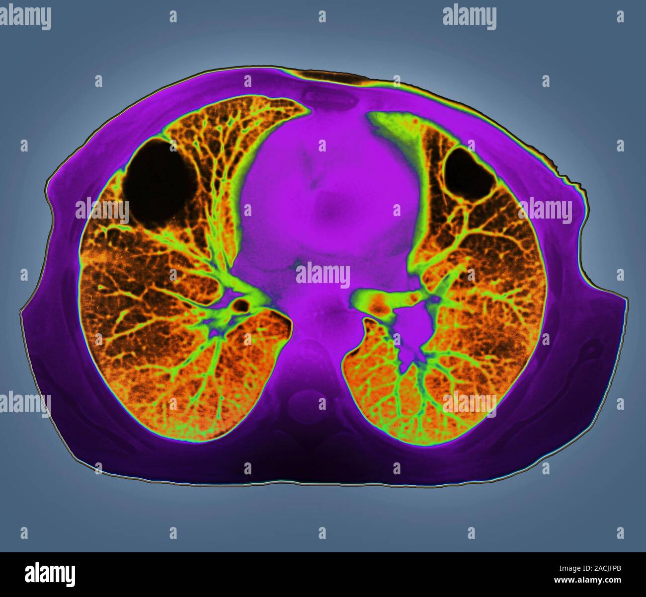 Coloured computed tomography (CT) scan in axial view of the lung fields ... Coloured computed tomography (CT) scan in axial view of the lung fields ...