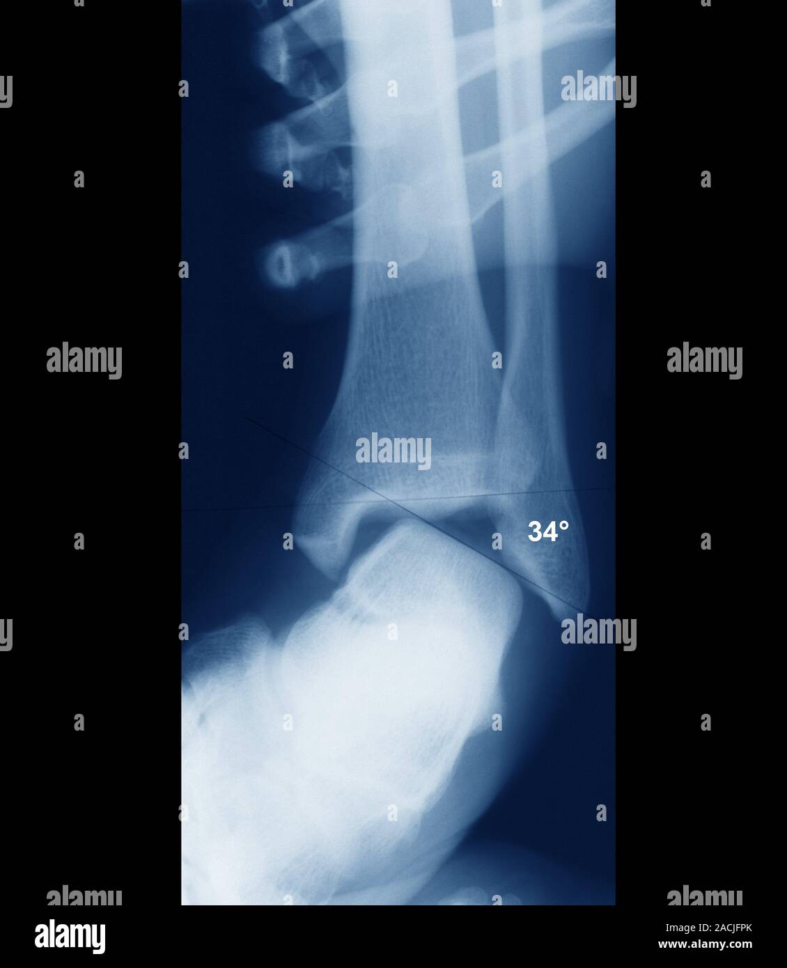 Coloured X-ray (posterior view) of the sprained ankle in a 25 year old ...