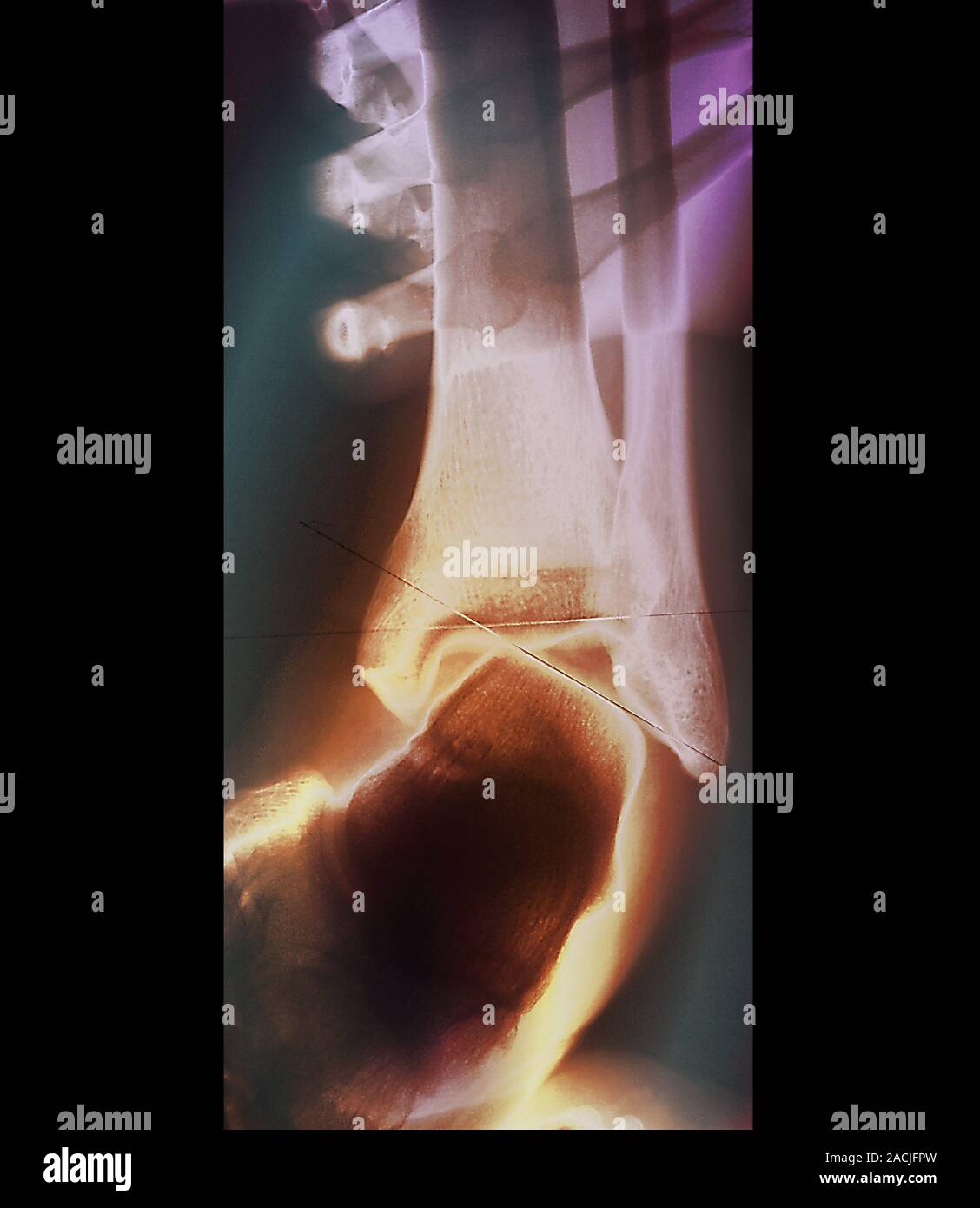 Footballers Ankle X Ray at Sylvia Partington blog