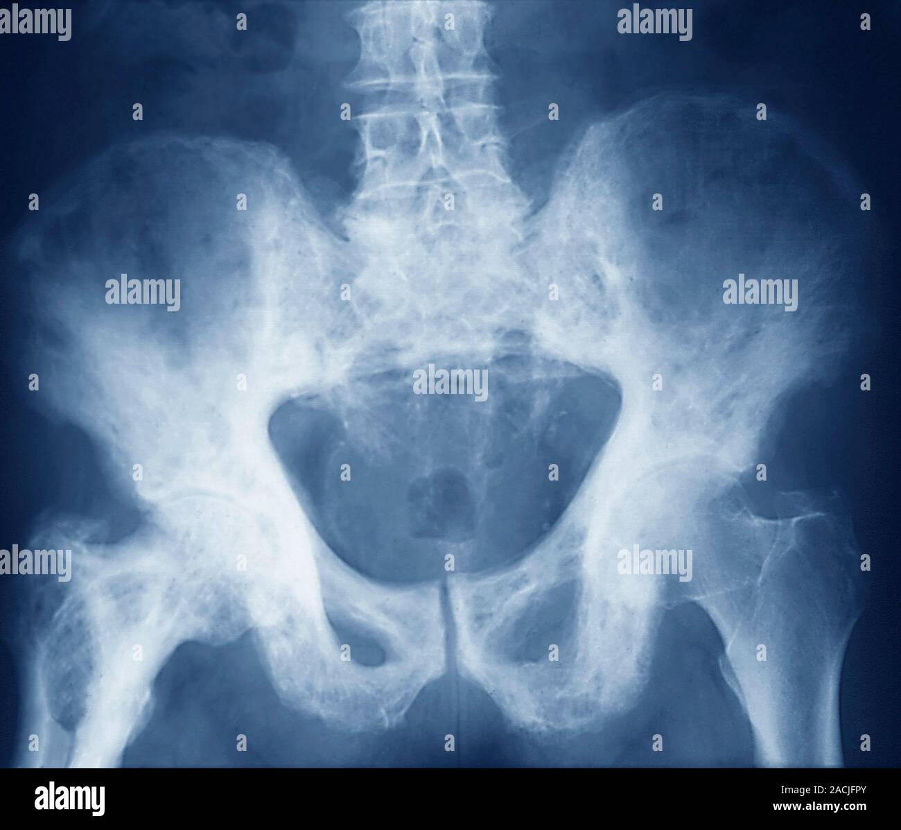 Coloured X-ray (front view) of the pelvis in a 60 year old patient ...