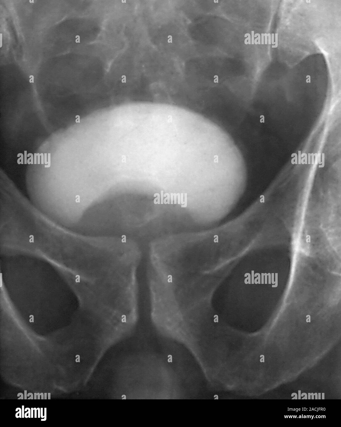 X-ray urogram of the pelvis in a 63 year old male patient showing the ...
