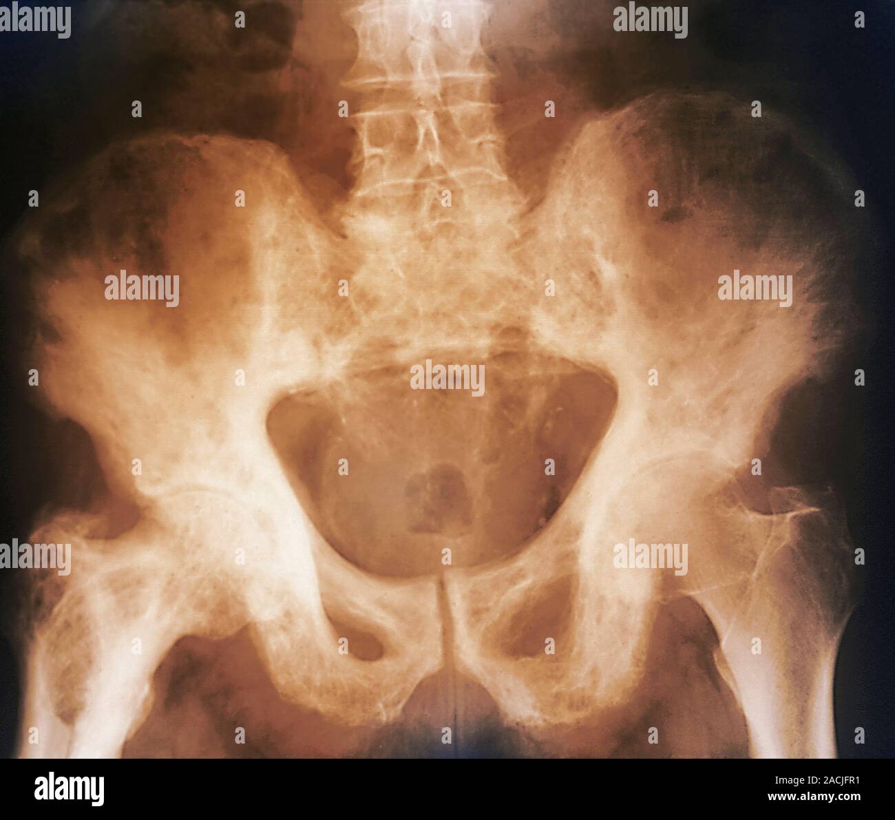 Coloured X-ray (front view) of the pelvis in a 60 year old patient ...