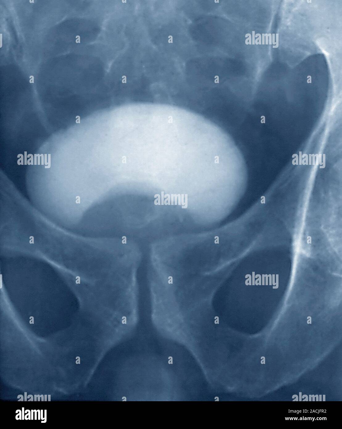 Coloured X-ray urogram of the pelvis in a 63 year old male patient ...
