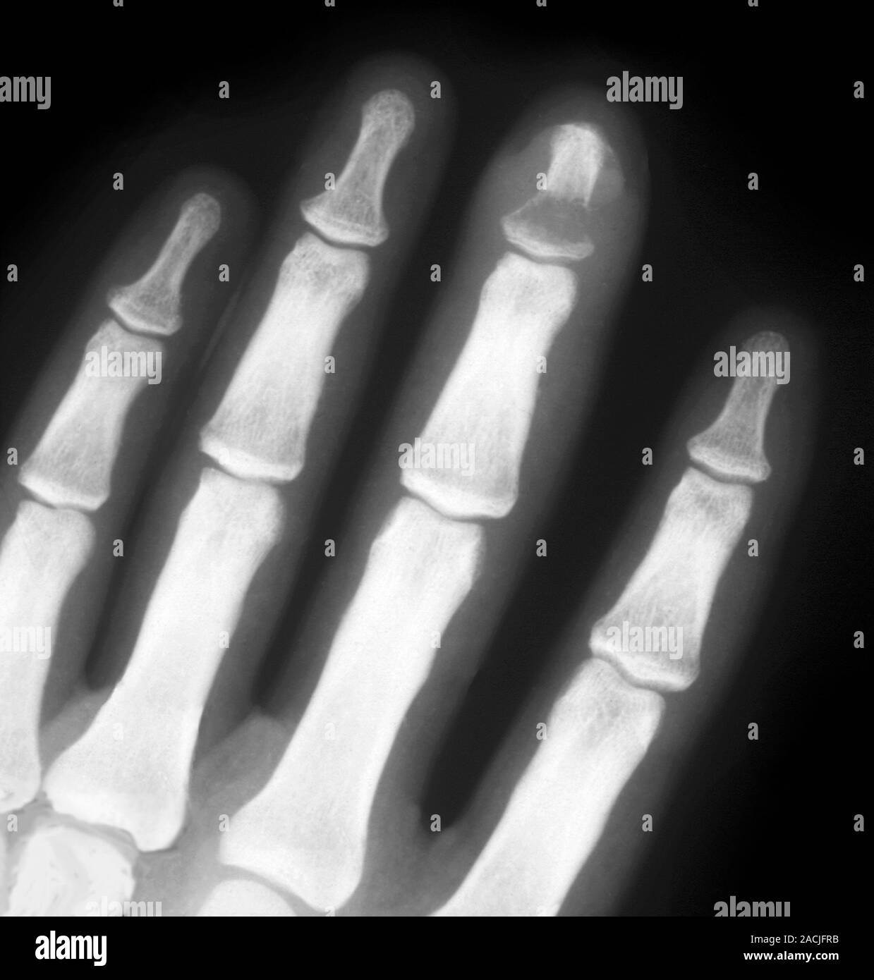 X-ray of the fingers of the left hand in a patient showing osteitis ...