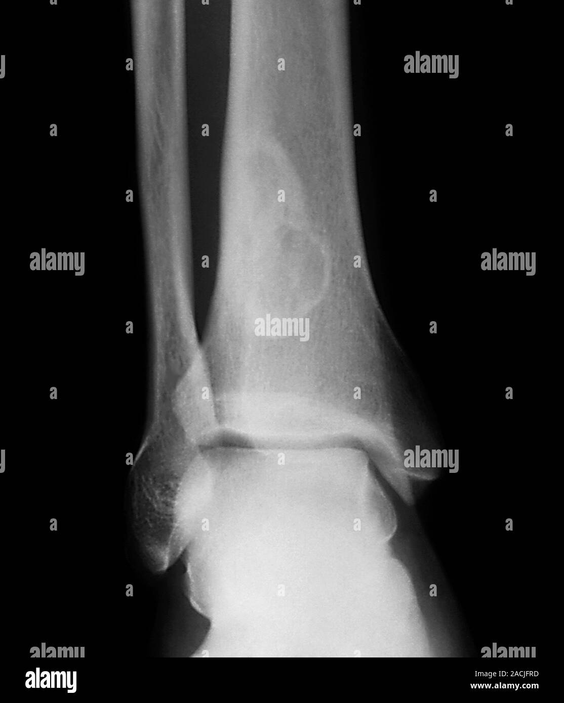 X-ray (posterior view) of the ankle in a patient showing an ossifying ...