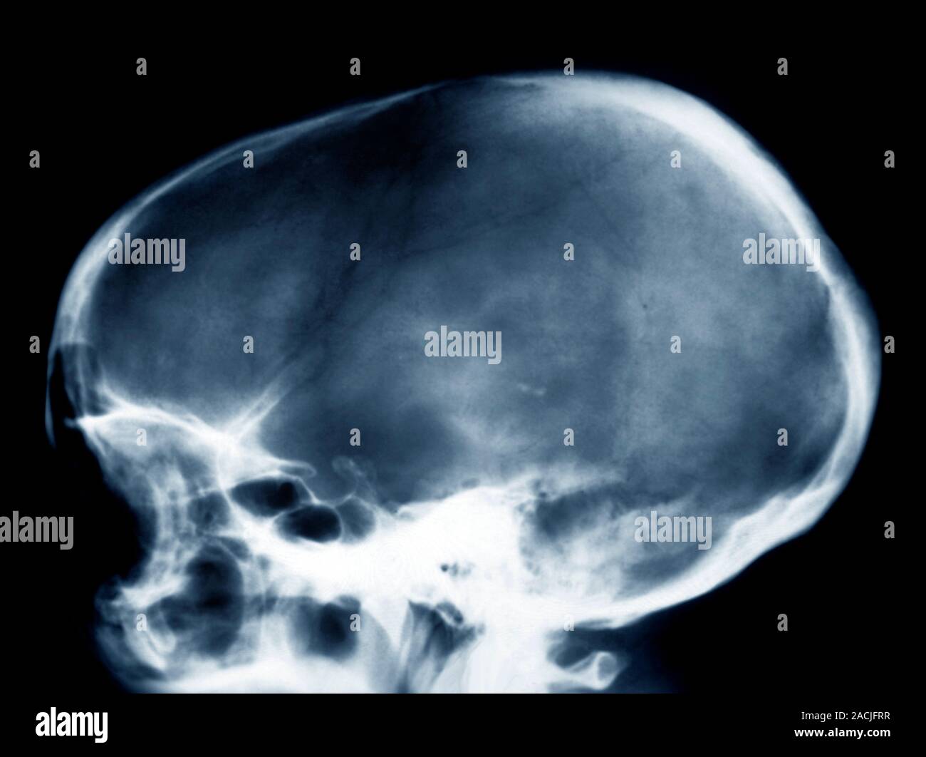 Coloured X-ray (side view) of the elongated skull (dolichocephalic ...
