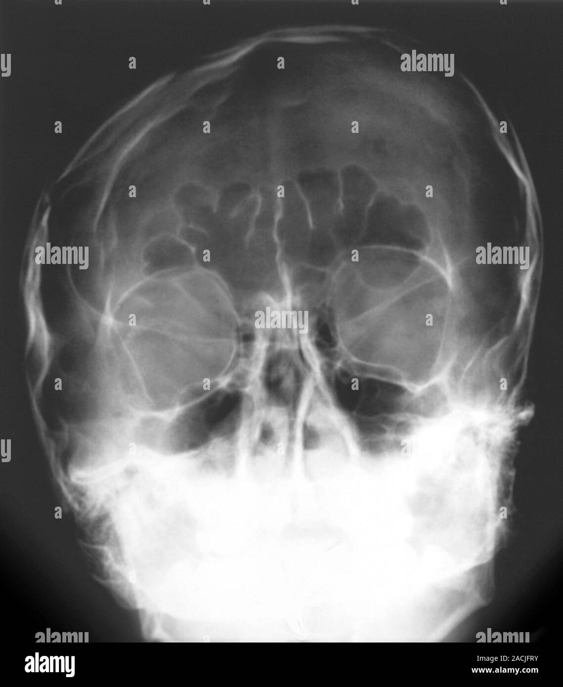 X-ray (front view) of the skull in an adult patient after an impact ...