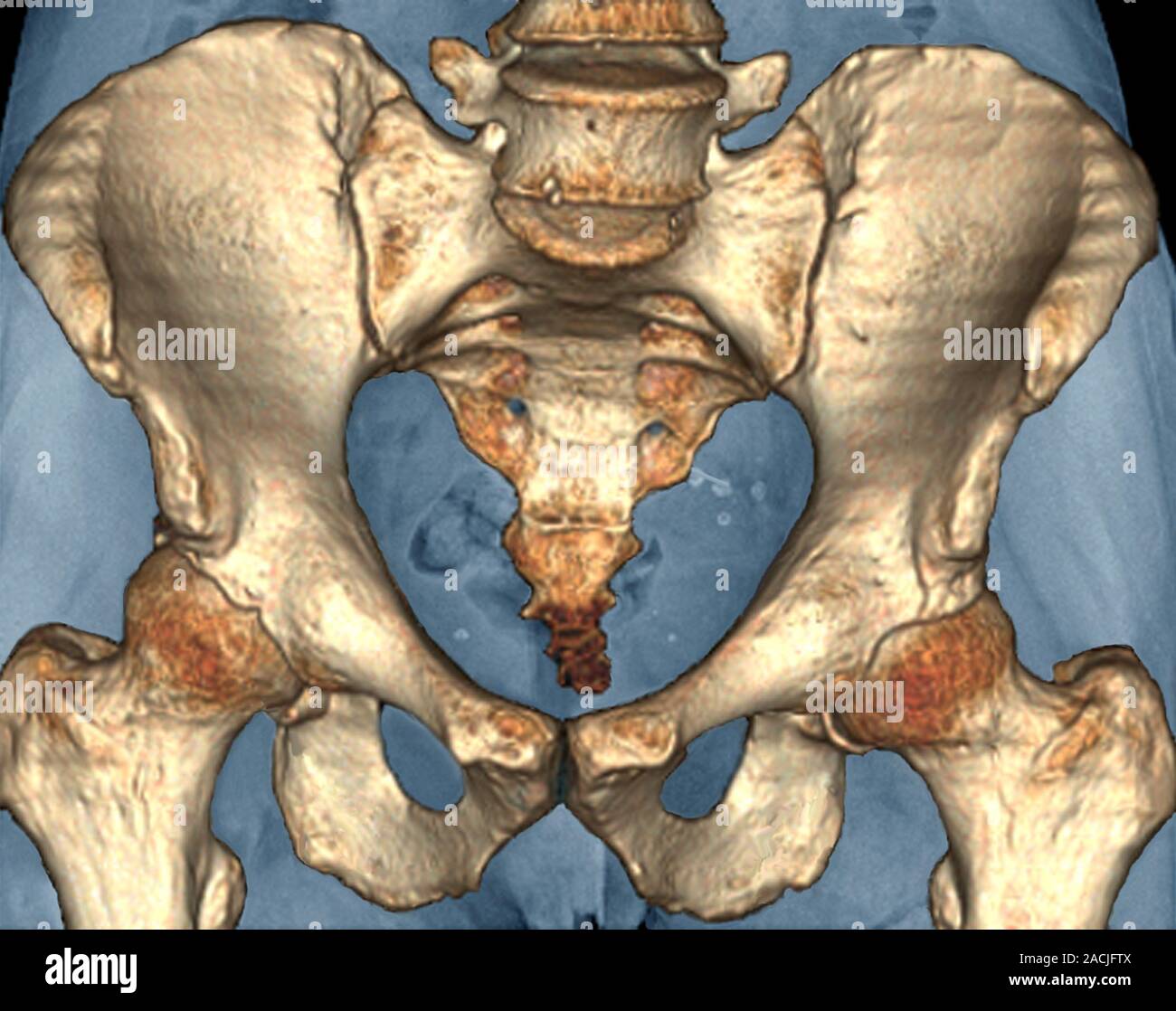 Coloured three-dimensional (3D) computed tomography (CT) scan in front view of the healthy ...