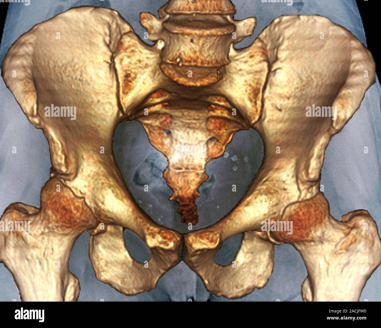Coloured three-dimensional (3D) computed tomography (CT) scan in front ...