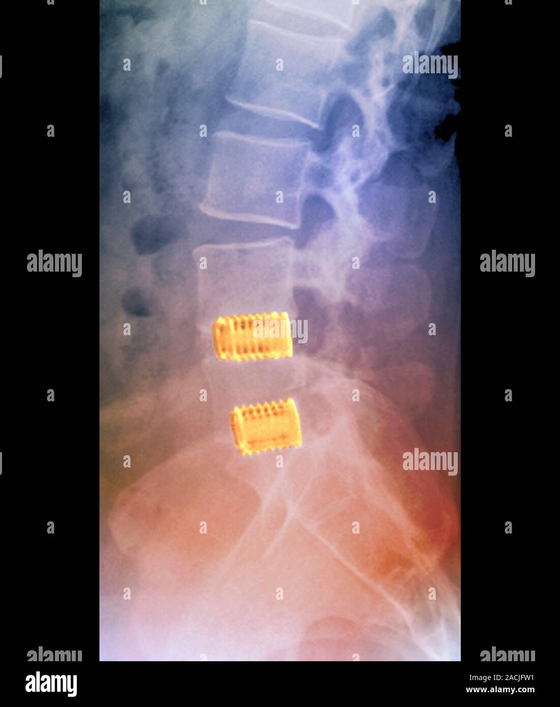 Coloured X-ray (side view) of the spine in a 45 year old patient with ...