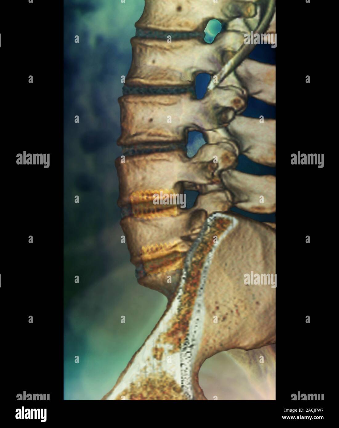 Coloured three-dimensional (3D) computed tomography (CT) scan in side view of the spine in a 45 ...