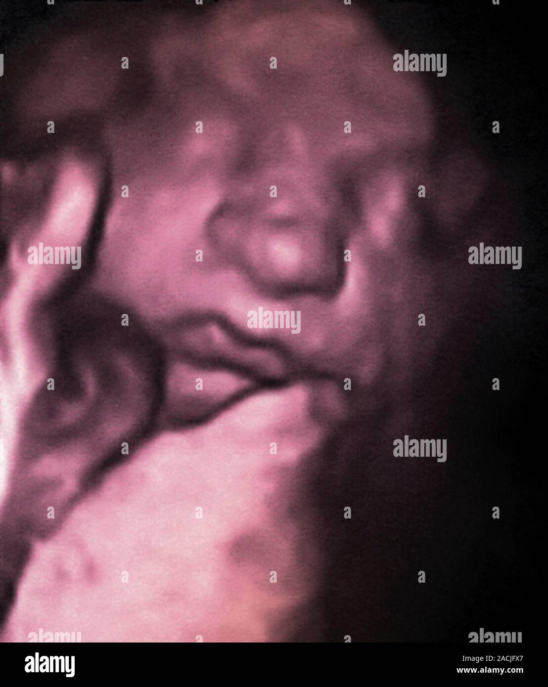 Coloured three-dimensional (3D) ultrasound scan of the face of a foetus ...