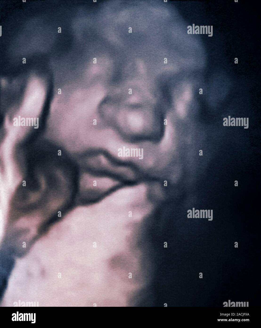 Coloured three-dimensional (3D) ultrasound scan of the face of a foetus ...