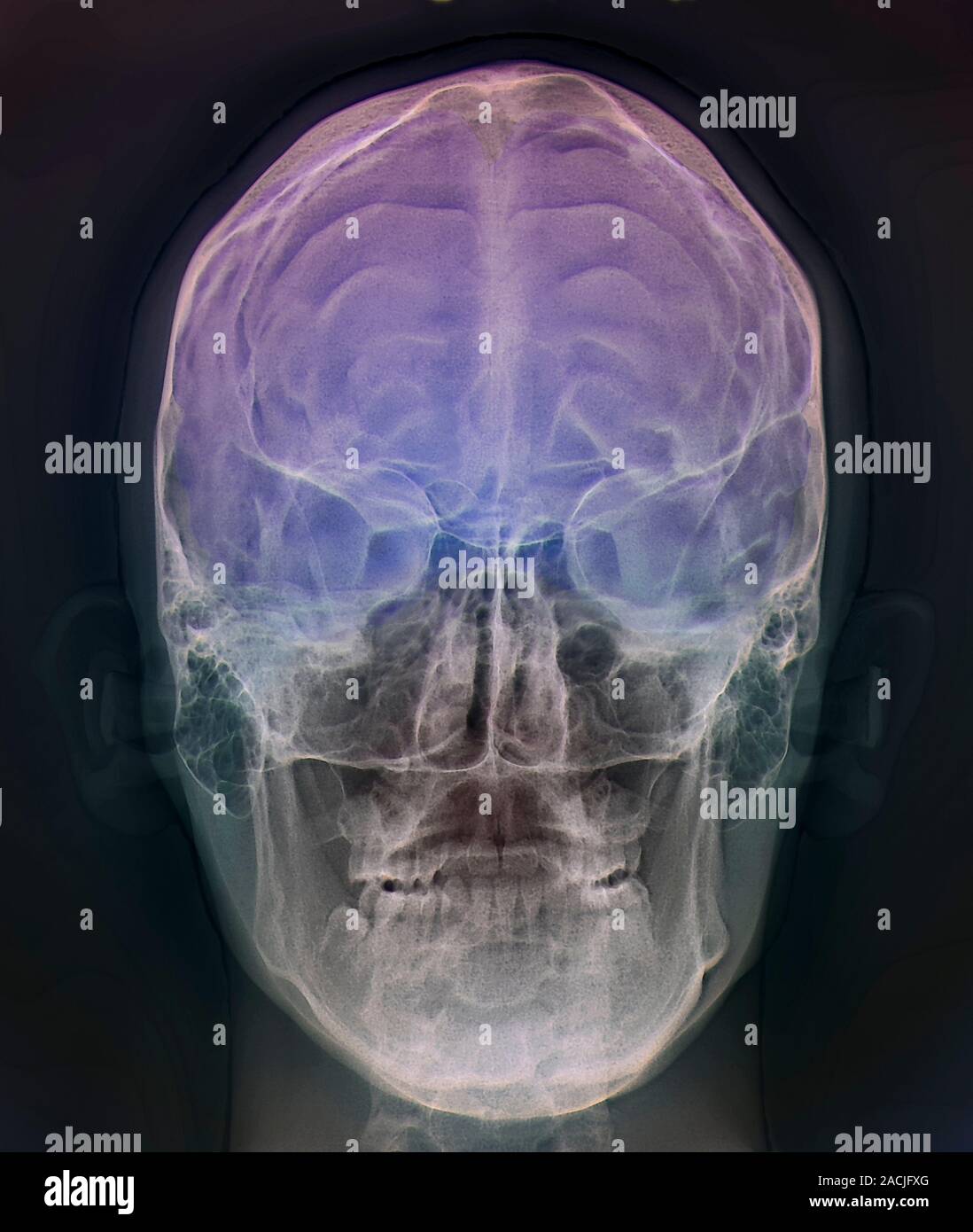 Coloured three-dimensional (3D) magnetic resonance imaging (MRI) scan in front view of the ...