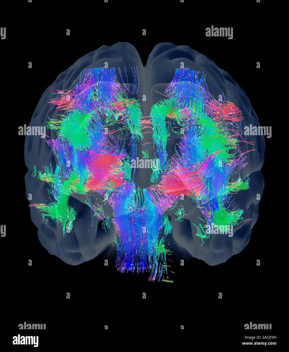 Coloured three-dimensional (3D) magnetic resonance imaging (MRI) scan in front view of the brain ...
