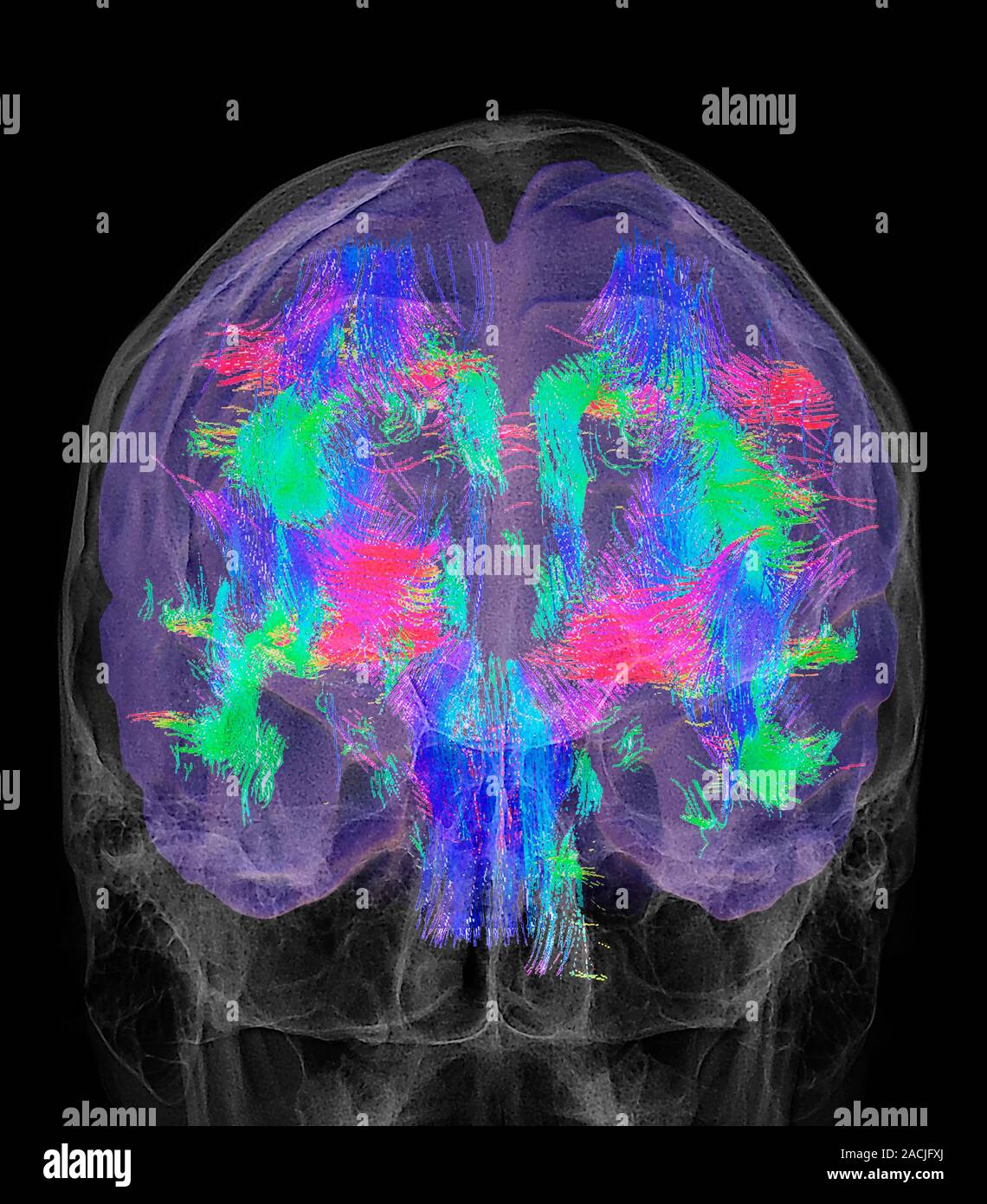 Coloured three-dimensional (3D) magnetic resonance imaging (MRI) scan ...