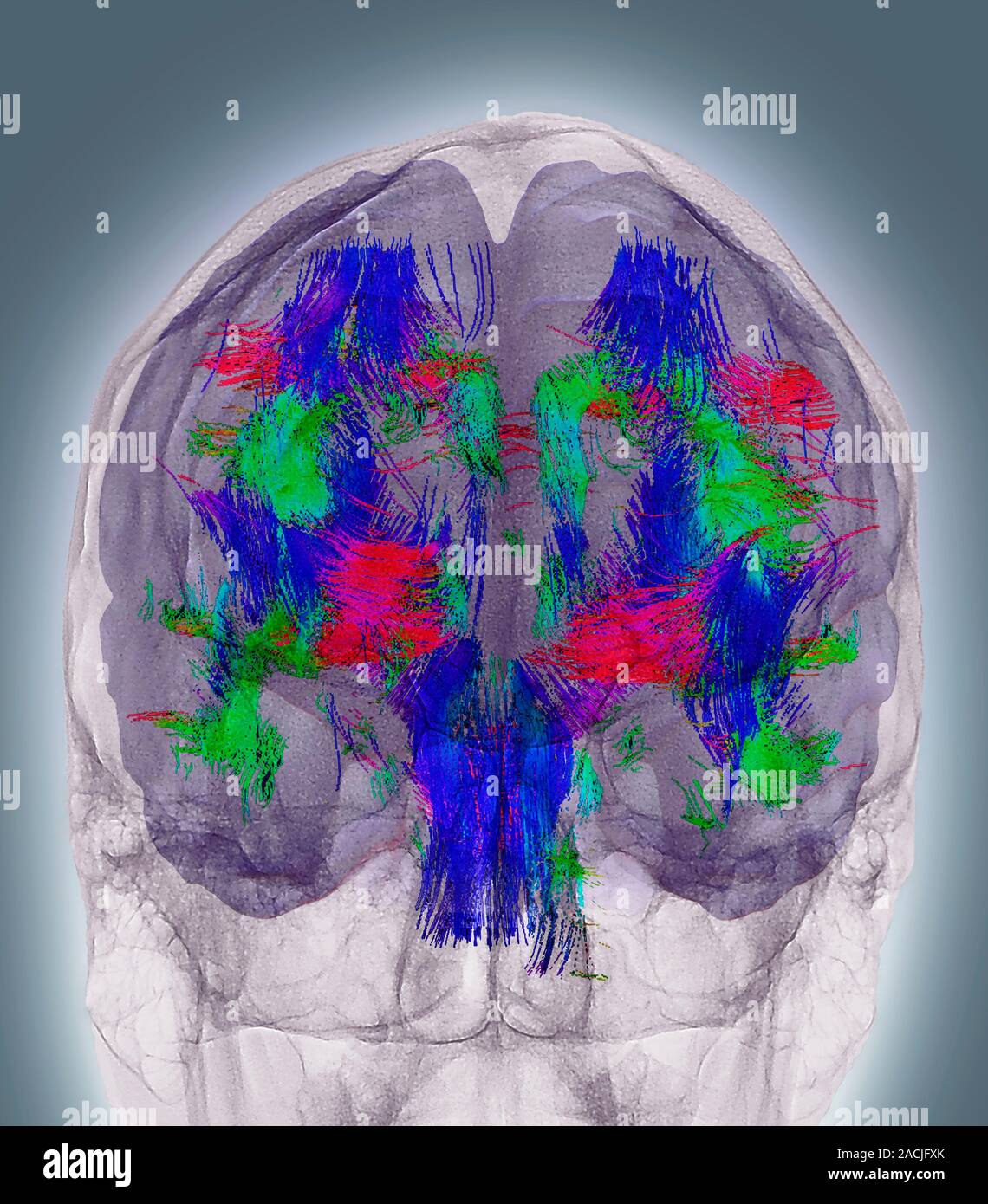 Coloured three-dimensional (3D) magnetic resonance imaging (MRI) scan ...