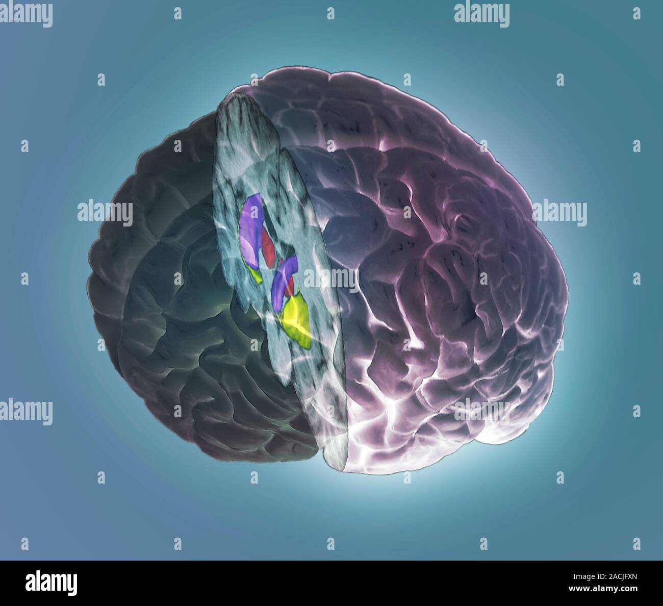Coloured three-dimensional (3D) magnetic resonance imaging (MRI) scan in side view of the ...