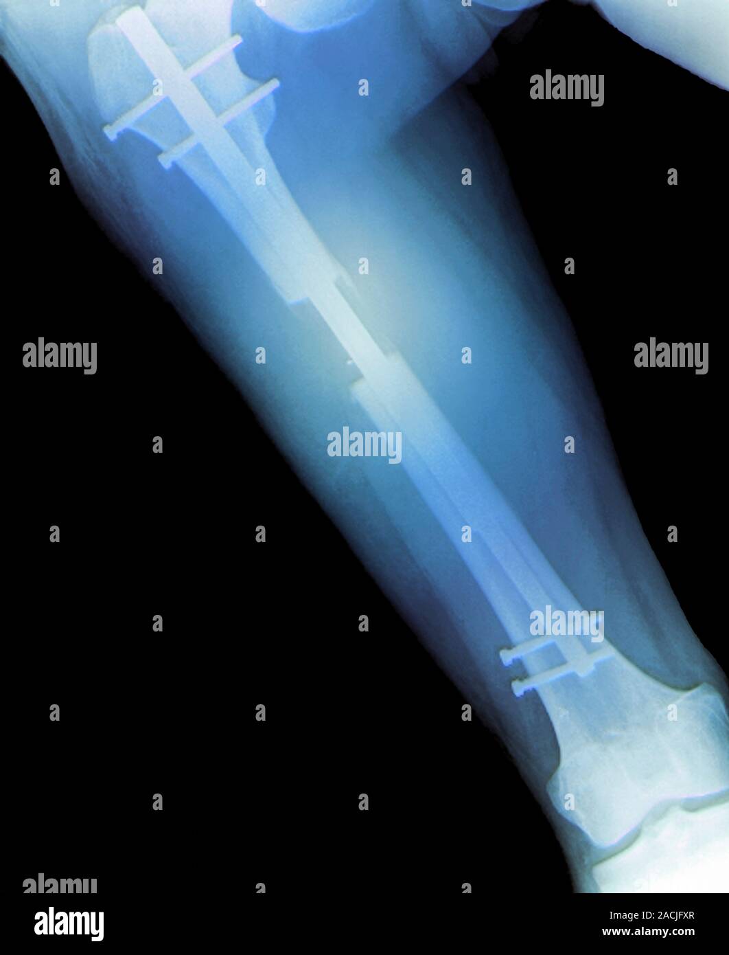 Coloured X-ray (front view) of the leg in a 25 year old patient showing ...