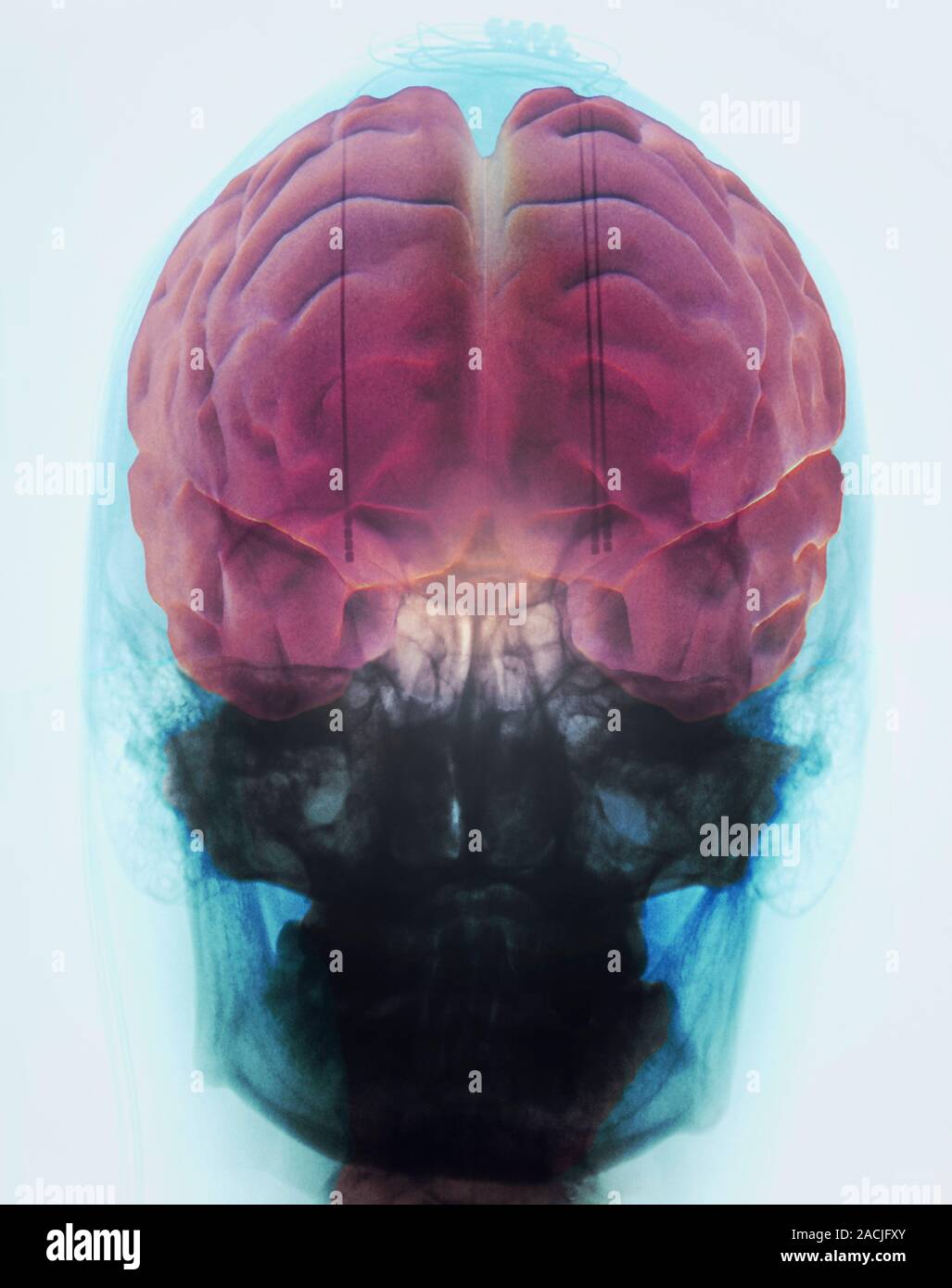 Coloured three-dimensional (3D) magnetic resonance imaging (MRI) scan in front view of the brain ...