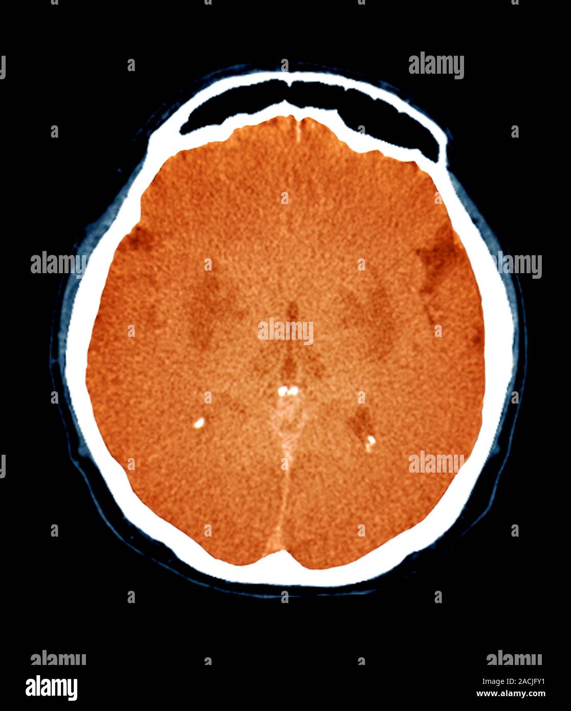 Coloured computed tomography (CT) scan in axial section of the brain of a 42 year old patient in ...