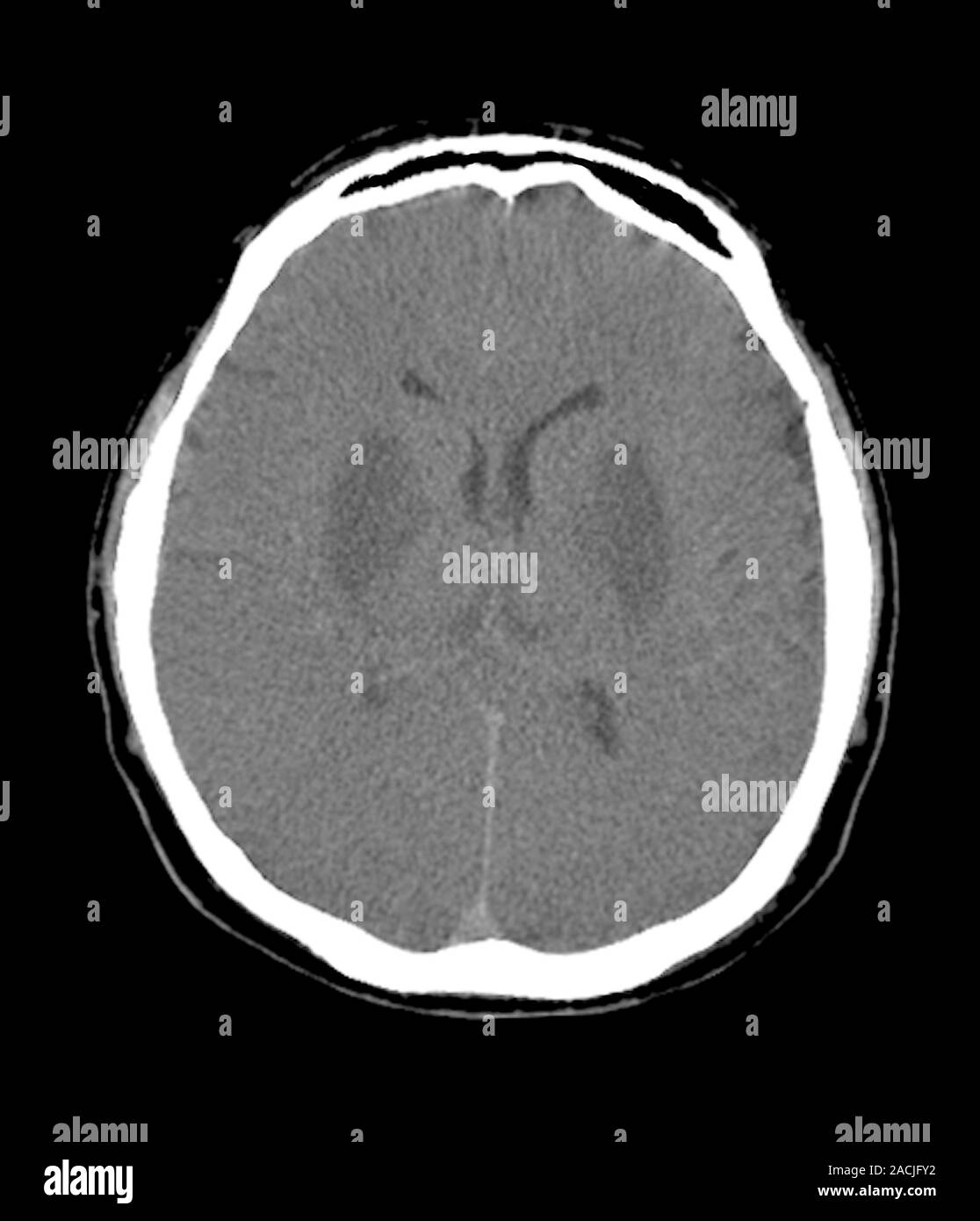 Computed tomography (CT) scan in axial section of the brain of a 42 ...