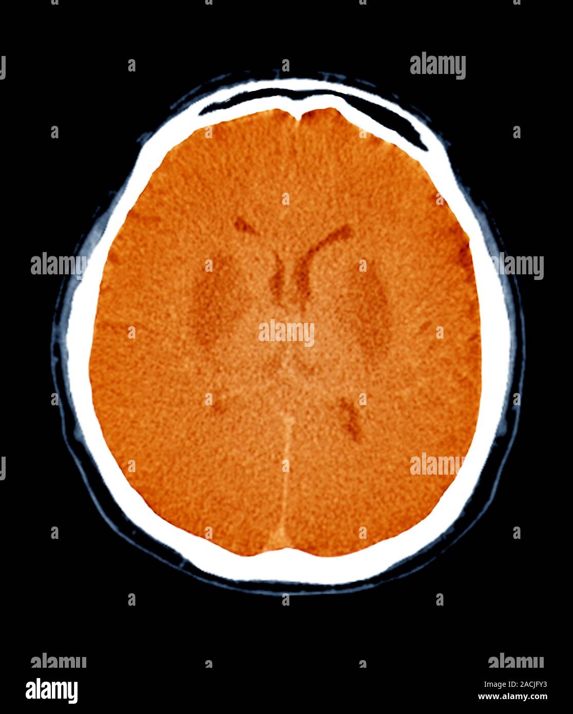 Coloured computed tomography (CT) scan in axial section of the brain of a 42 year old patient in ...