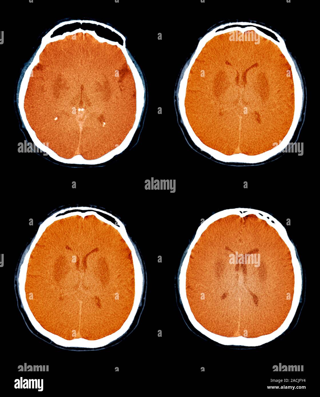 Coloured computed tomography (CT) scans in axial section of the brain of a 42 year old patient ...